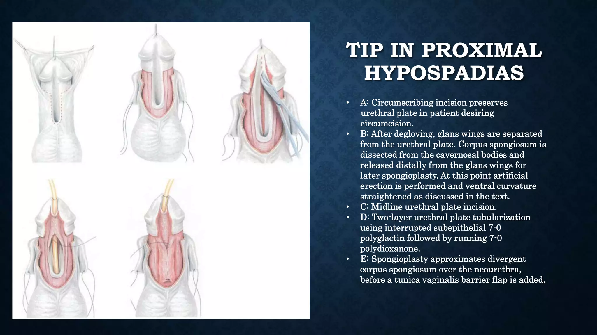 Hypospadias, epispadias and bladder exstrophy | PPTX