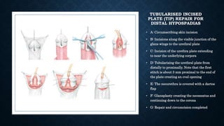 Hypospadias, epispadias and bladder exstrophy | PPT