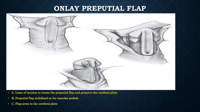 Hypospadias, epispadias and bladder exstrophy | PPT