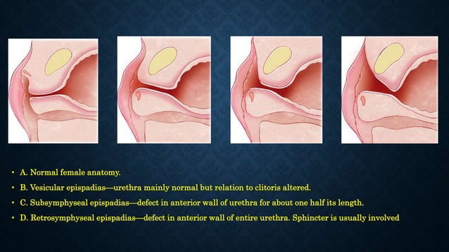 Hypospadias, epispadias and bladder exstrophy | PPT