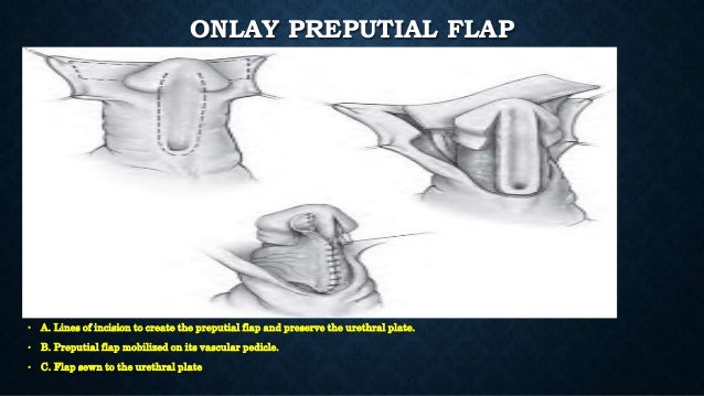 Hypospadias, epispadias and bladder exstrophy
