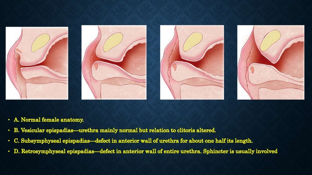 Hypospadias, epispadias and bladder exstrophy