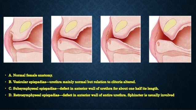 Hypospadias, epispadias and bladder exstrophy