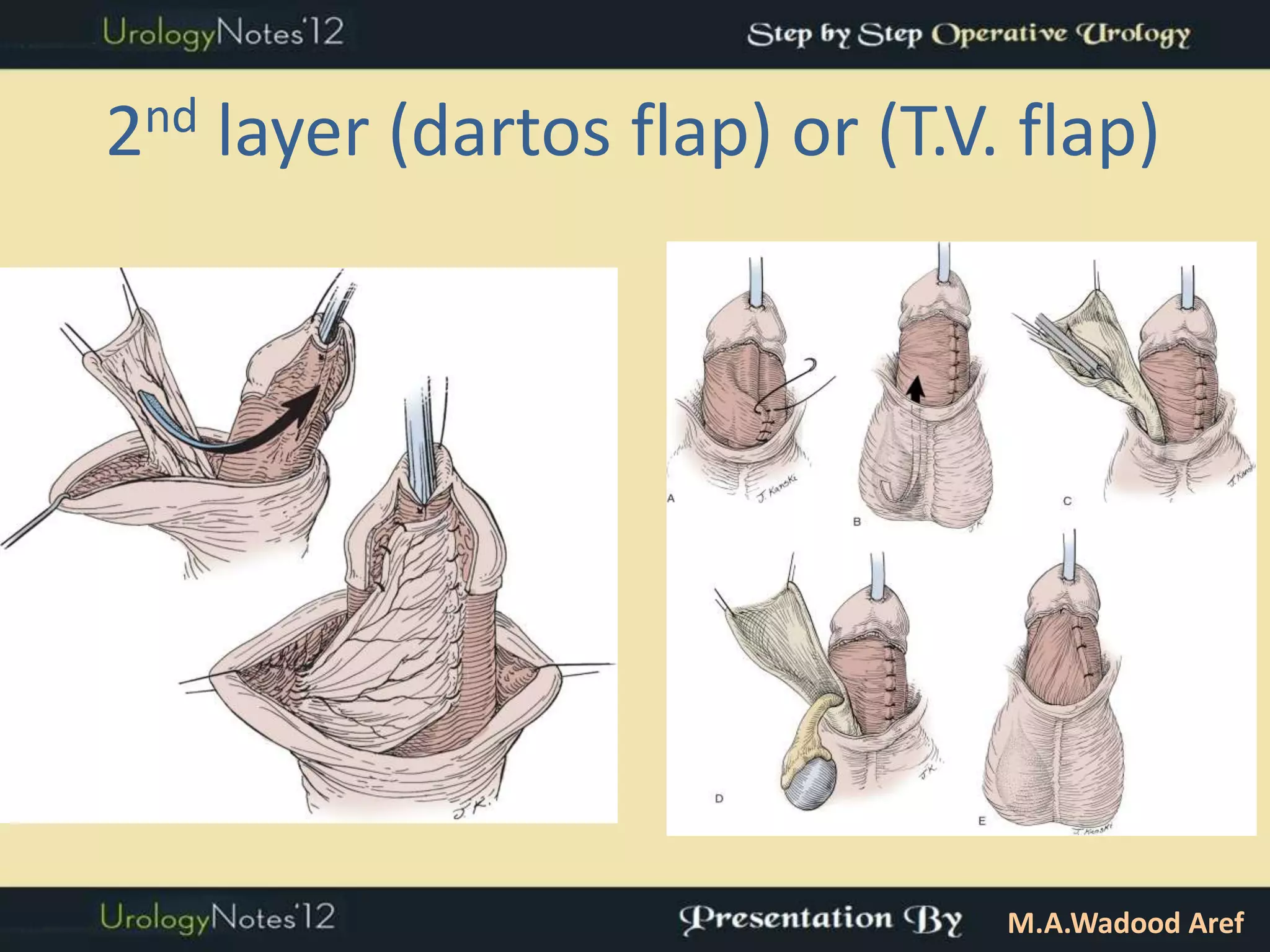 Hypospadias 2 orthoplasty & ttt options step by step oper series | PDF