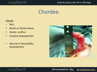 Hypospadias 2 orthoplasty & ttt options step by step oper series | PPT