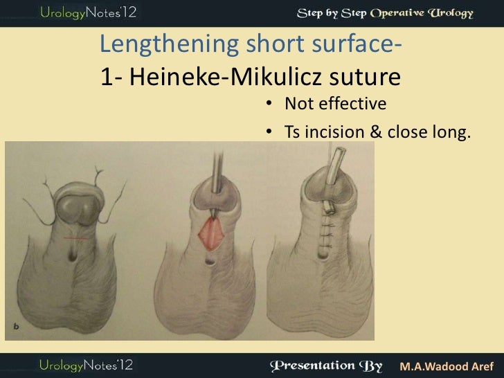 Hypospadias 2 orthoplasty & ttt options step by step oper series