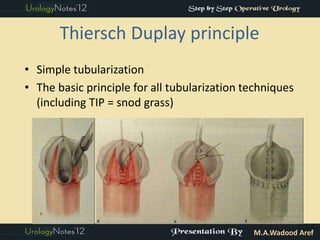 Hypospadias 3: MAGPI & snod grass (TIP) step by step operative urology ...
