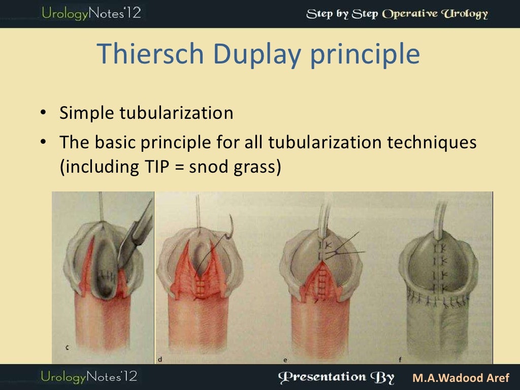 Hypospadias 3: MAGPI & snod grass (TIP) step by step operative urol…