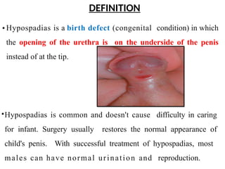 hypospadias AND epispadias .pptx