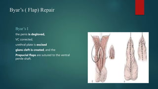 Hypospadias cripple - Staged reconstruction | PPTX