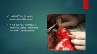 Hypospadias cripple - Staged reconstruction | PPT