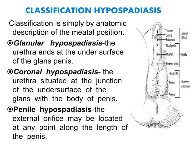 Nursing Management of Patient with Hypospadiasis & epispadias | PPT