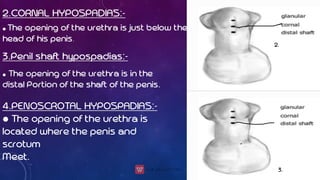 hypospadiasis presentation.pdf