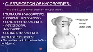 hypospadiasis presentation.pdf