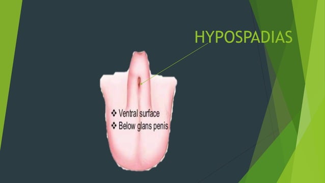 Hypospadias ppt