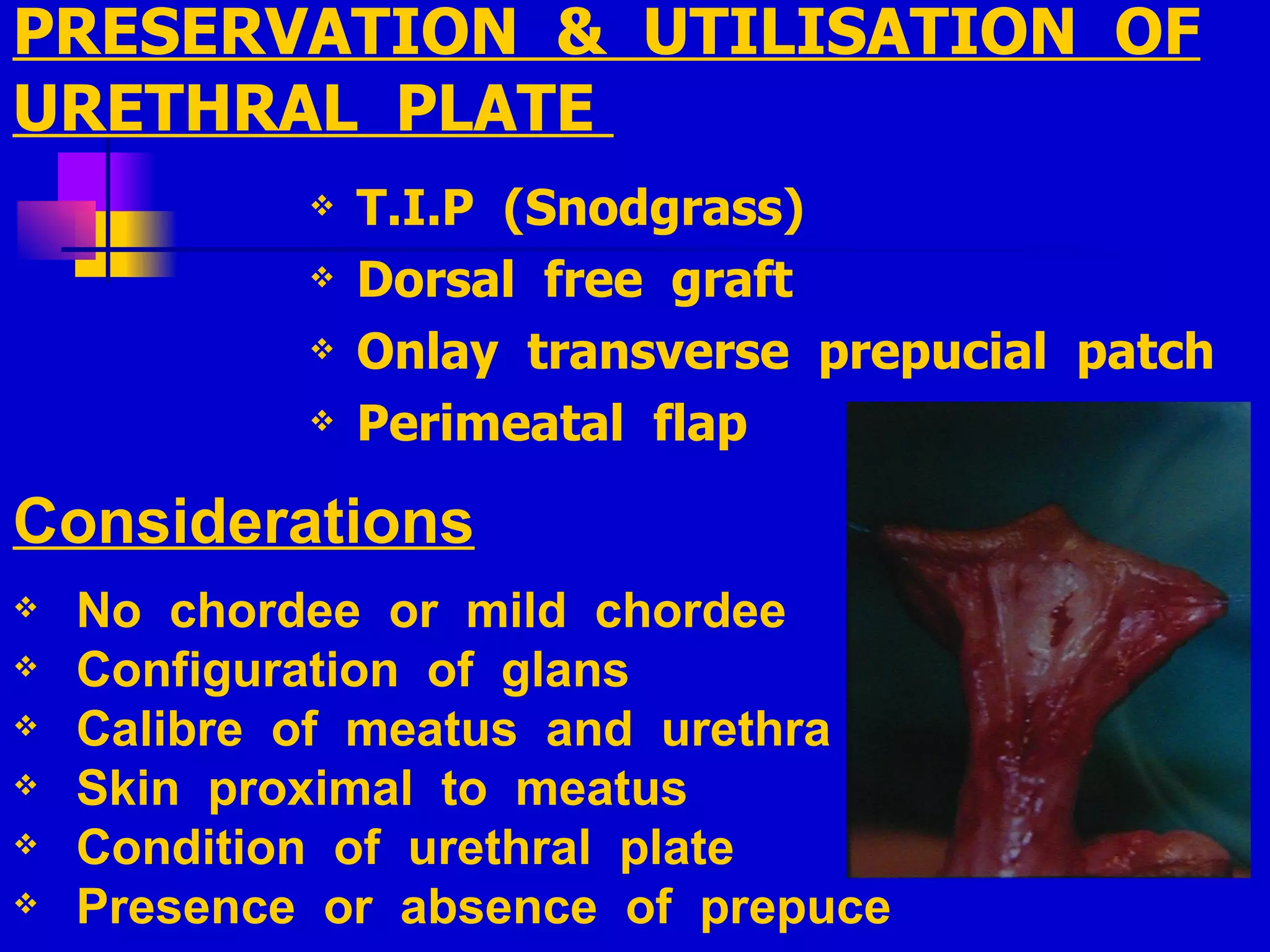Hypospadias Surgery ,How To Avoid Complications | PPT