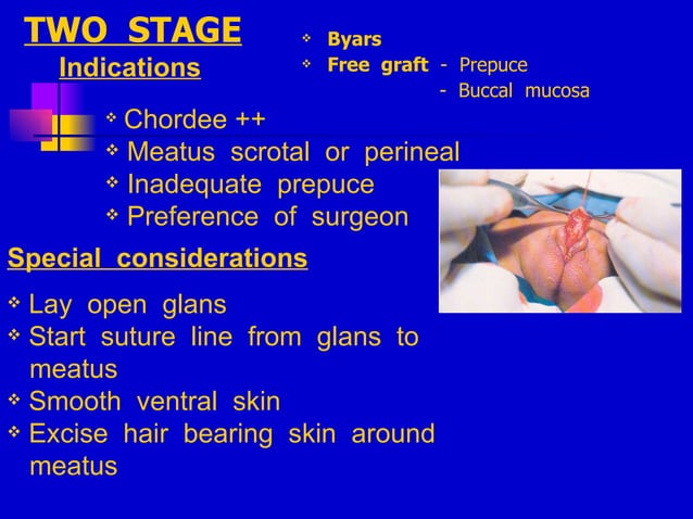 Hypospadias Surgery ,How To Avoid Complications