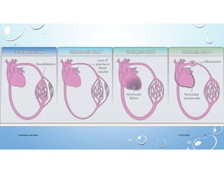 Fluid resuscitation,Hypovolemic shock ,Major hemorrhage | PPT
