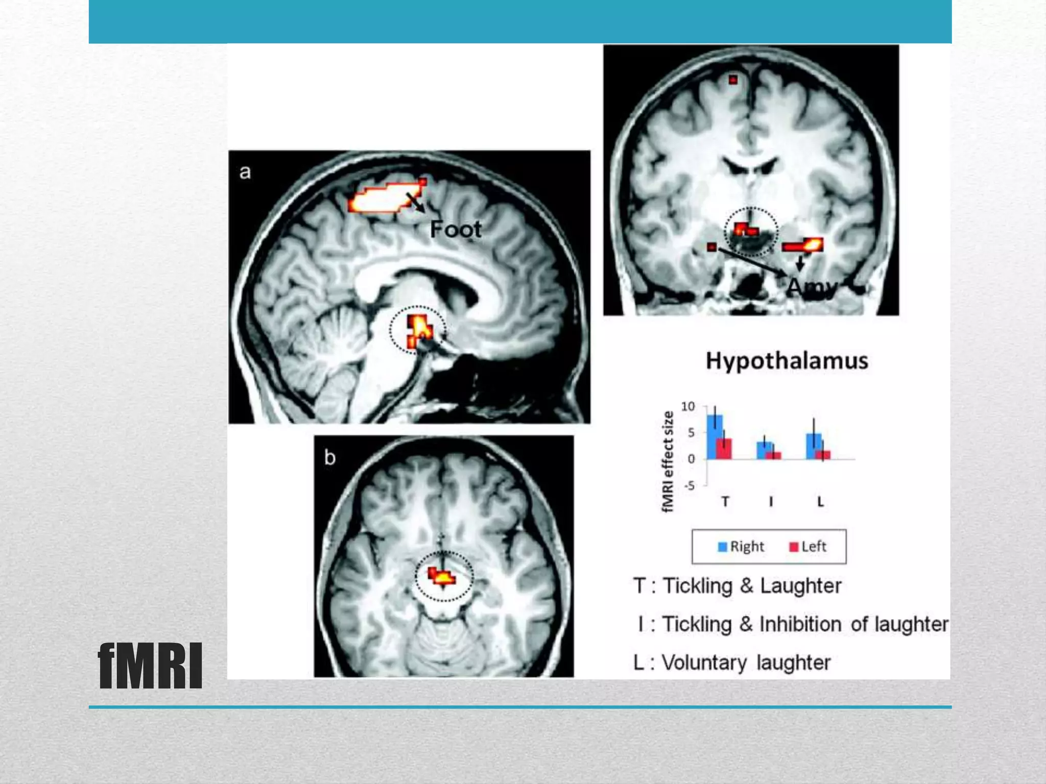 Disorder of Hypothalamus | PPTX