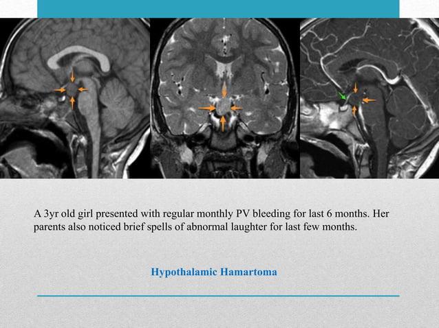 Disorder of Hypothalamus | PPTX