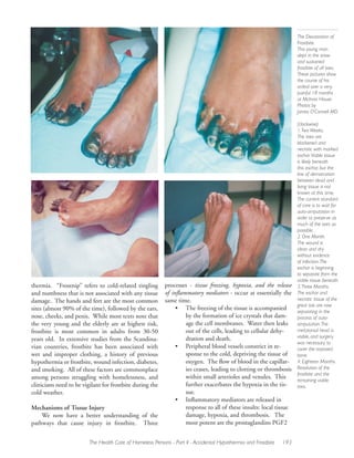 Hypothermia and Frostbite in Homeless Populations | PDF | Injuries ...