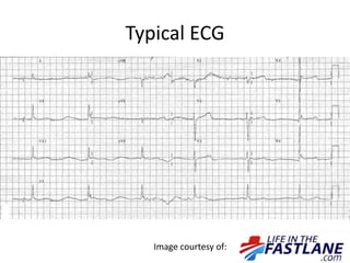 Hypothermia and cold injuries | PPTX
