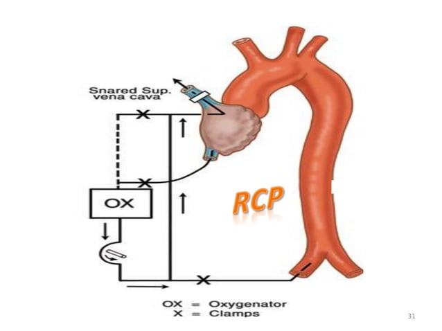 Hypothermia, DHCA, RCP, ACP,Oxygen consumption,Cooling, Rewarming ...