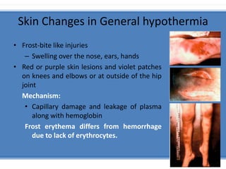 Hyperthermia Skin Color