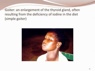 Diagnosis and treatment of hypothyroidism.pptx