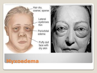 Hypothyroidism | PPTX