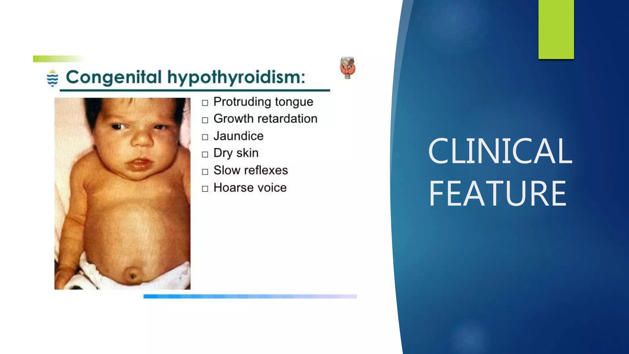 Hypothyroidism | PPT