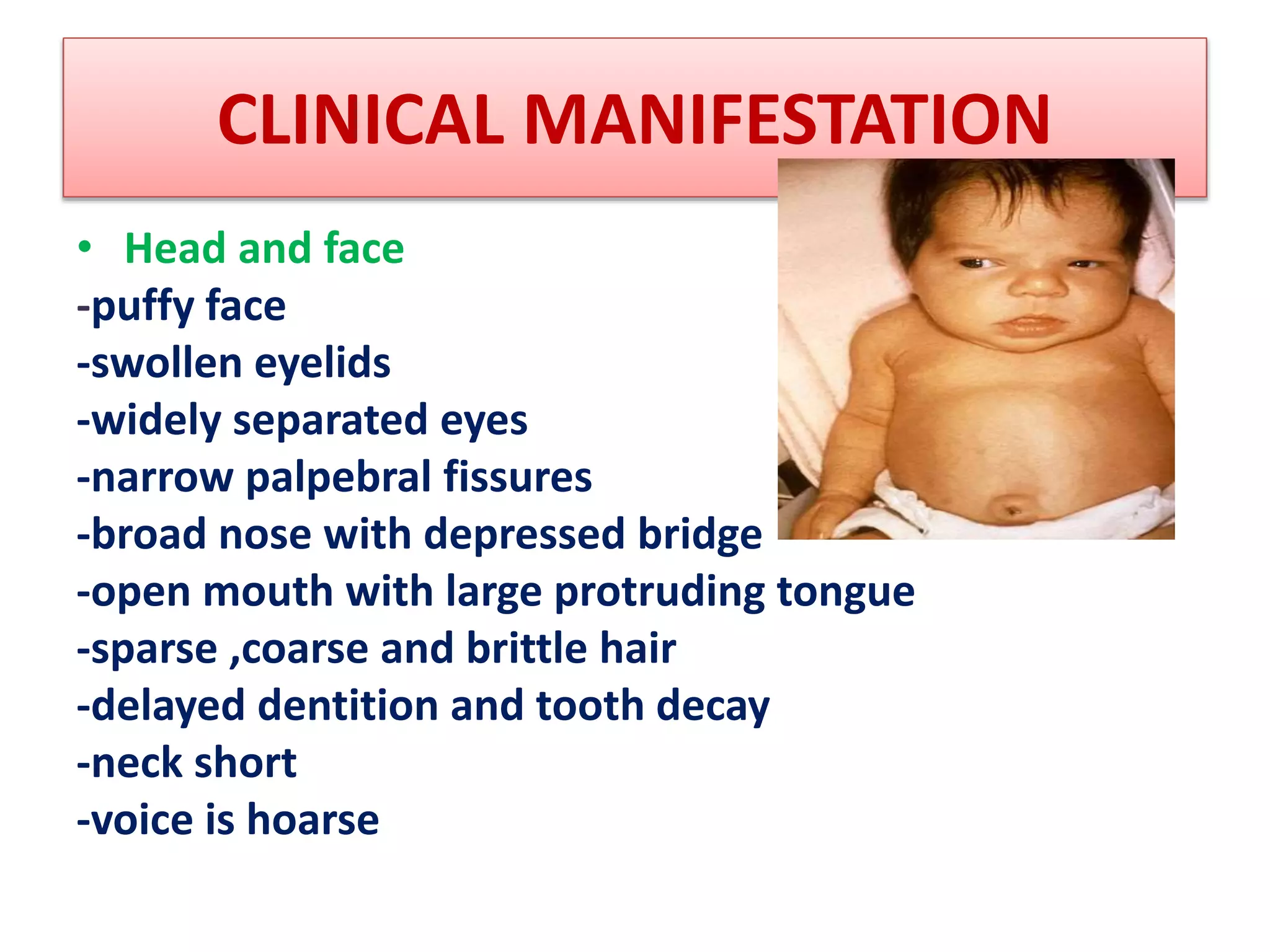 Hypothyroidism in children | PPTX