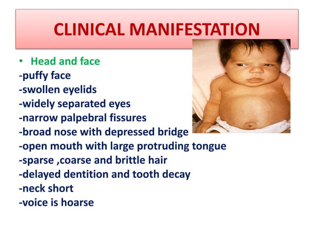 Hypothyroidism in children | PPTX