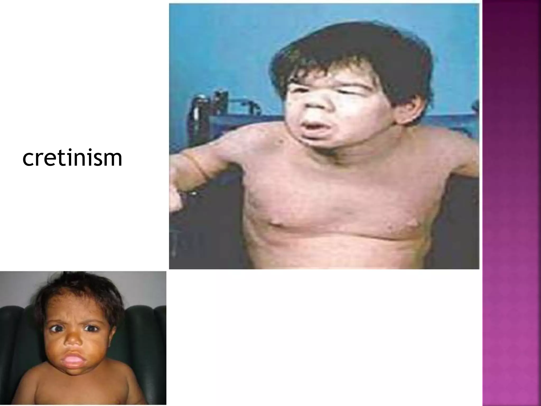 Hypothyroidism | PPTX
