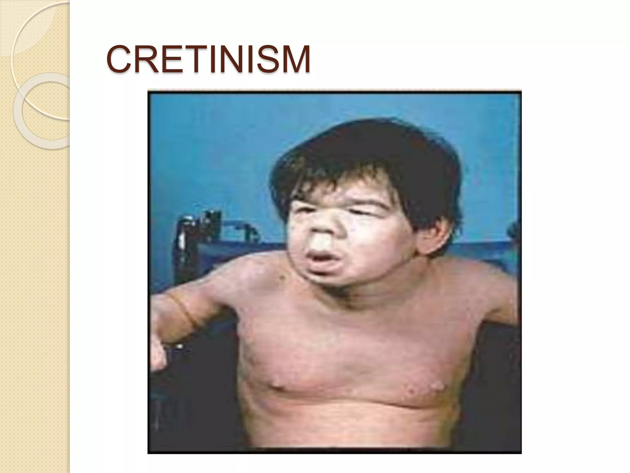 Hypothyroidism.pptx