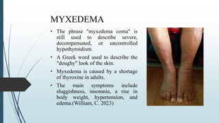 Hypothyroidism.pdf