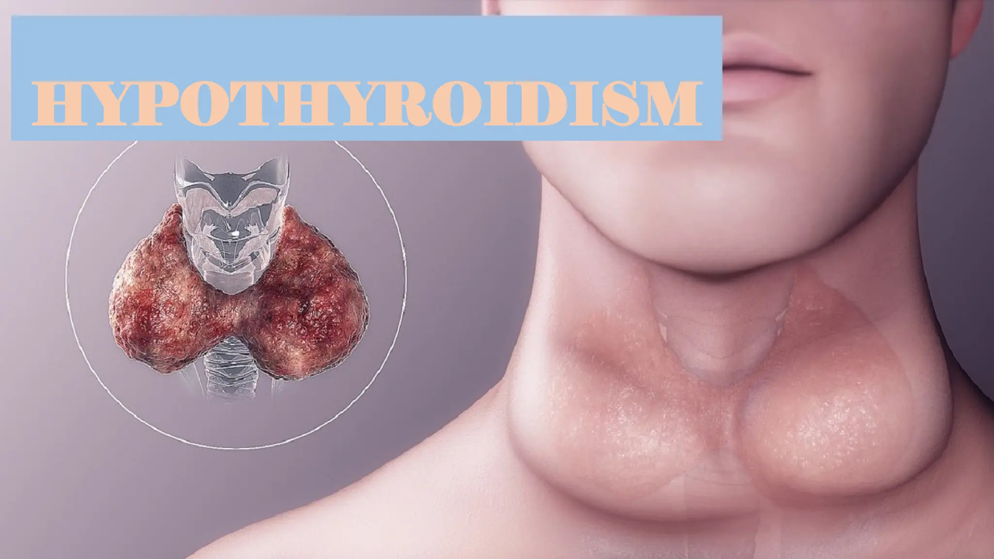 thyroid disorder HYPOTHYROIDISM disorder.pptx