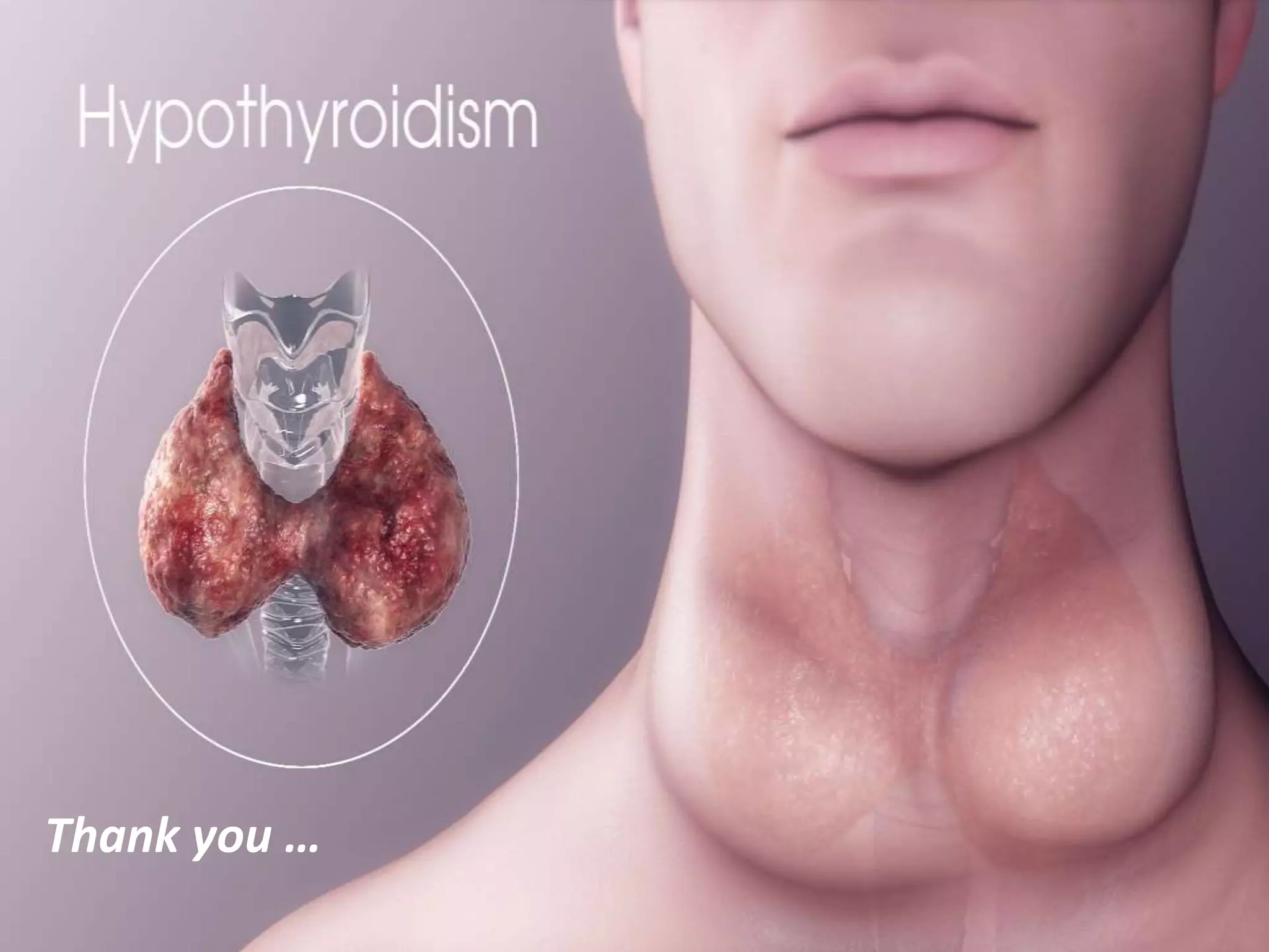Hypothyroidism case presentation | PPTX