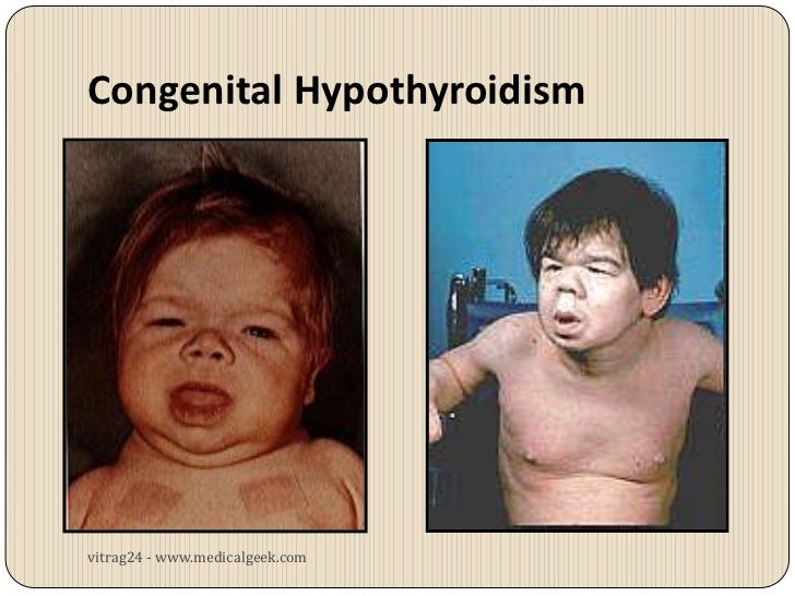 Congenital Hypothyroidism