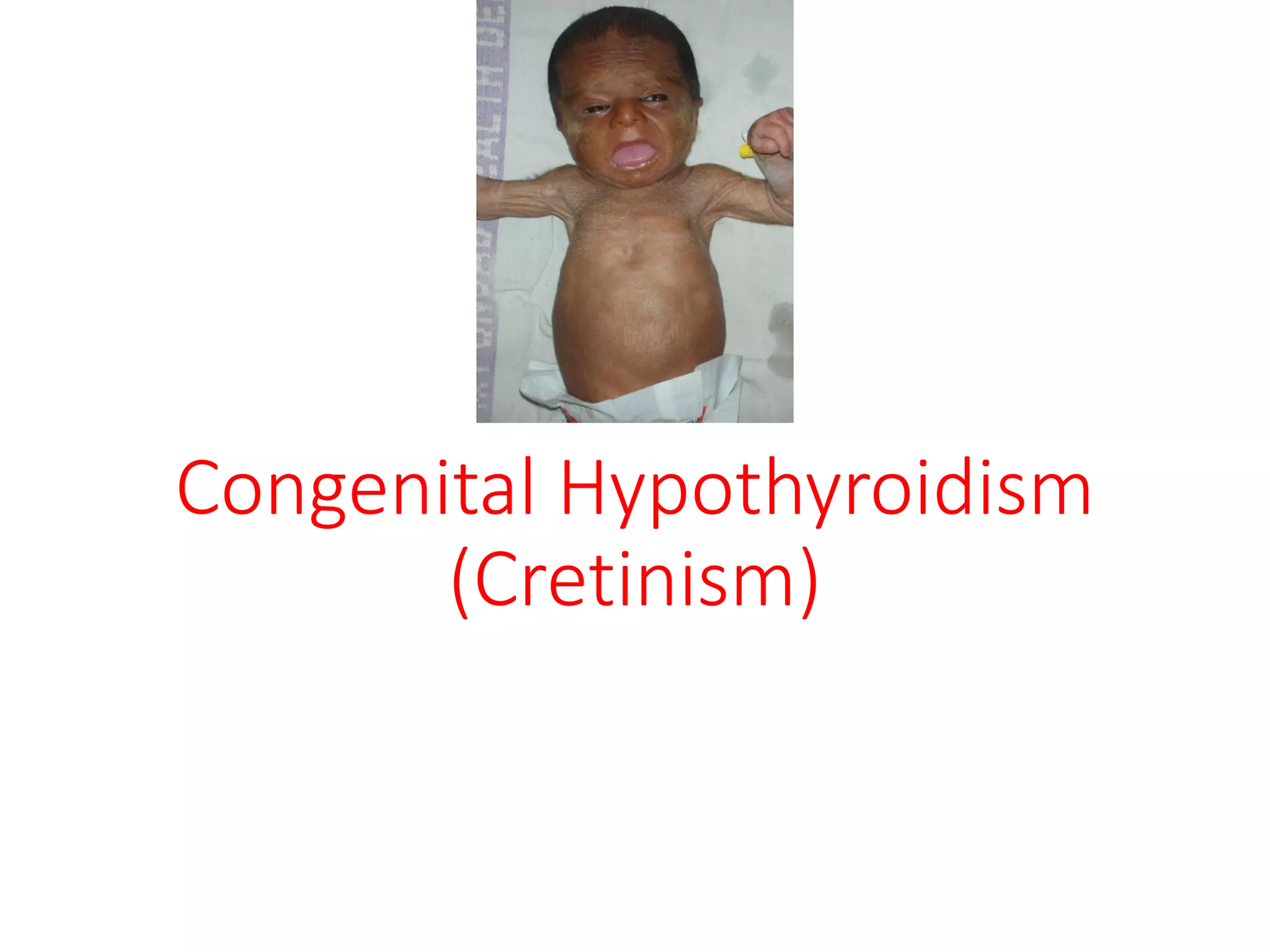 Hypothyroidism in children 2021 | PDF