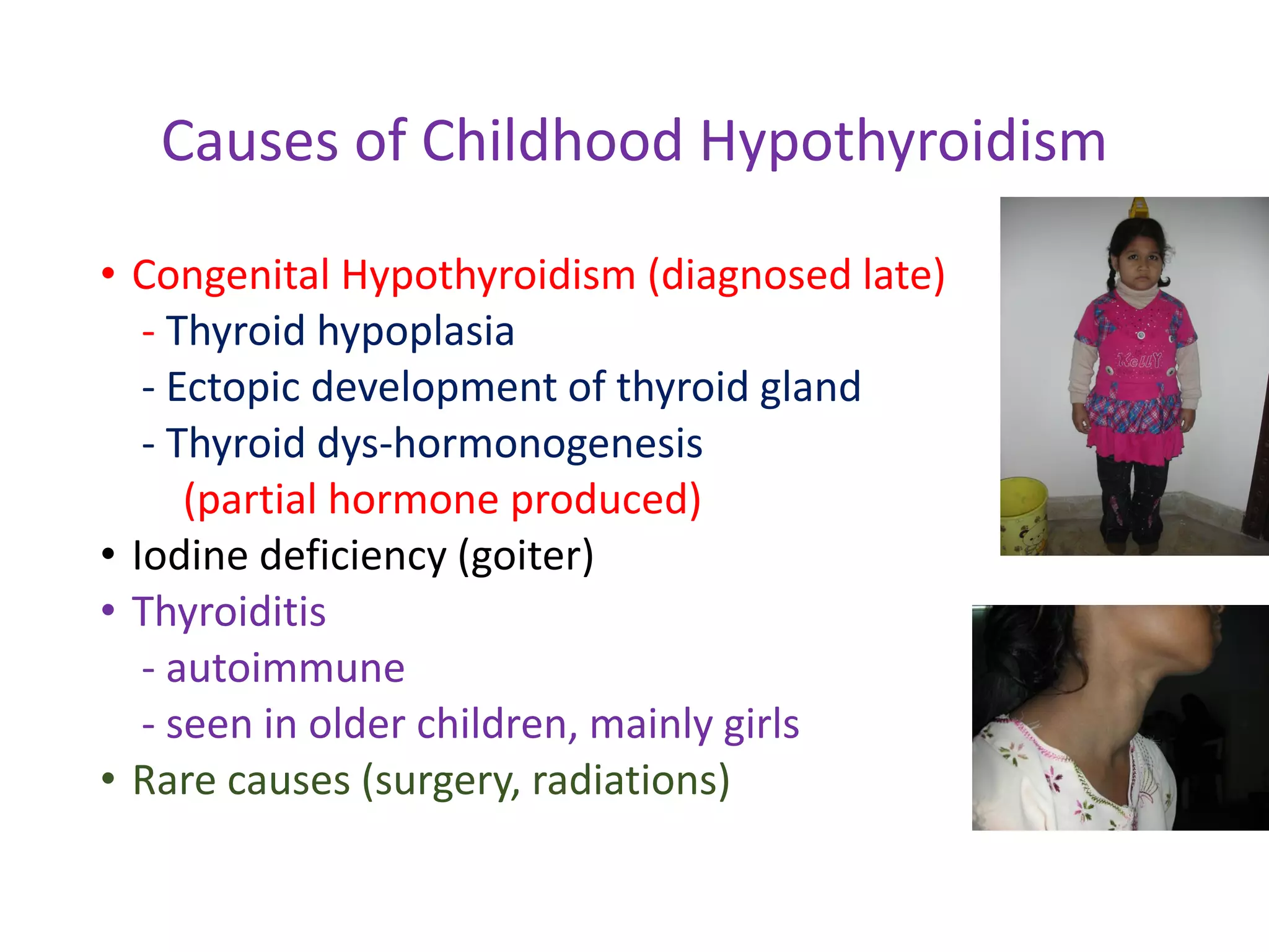 Hypothyroidism in children 2021 | PDF