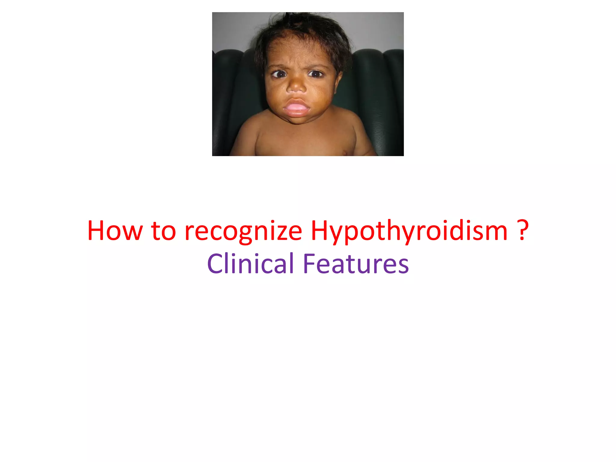 Hypothyroidism in children 2021 | PDF