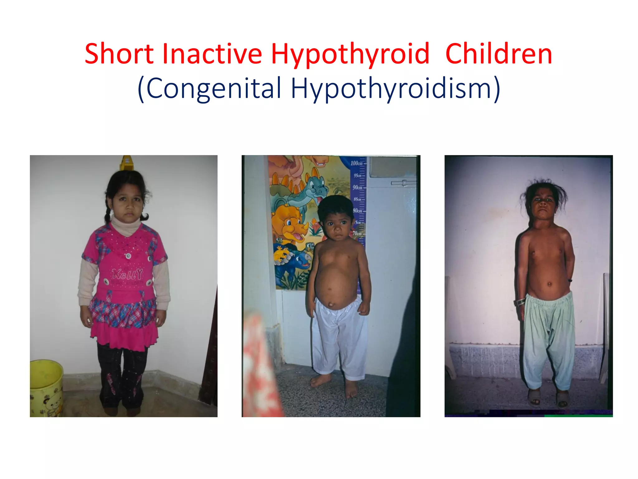 Hypothyroidism in children 2021 | PDF