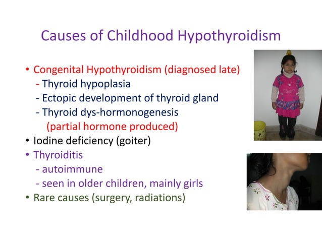 Hypothyroidism in children 2021 | PDF | Thyroid Disorders | Endocrine ...