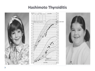 hypothyroidisminchildren2023 sahiwal.pptx