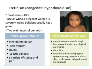 hypothyroidisminchildren2023 sahiwal.pptx