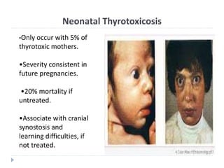 hypothyroidisminchildren2023 sahiwal.pptx