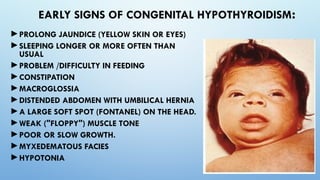 HYPOTHYROIDISM IN NEWBORN slide .pptx