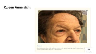 hypothyroidism for MBBS first year students | PPT