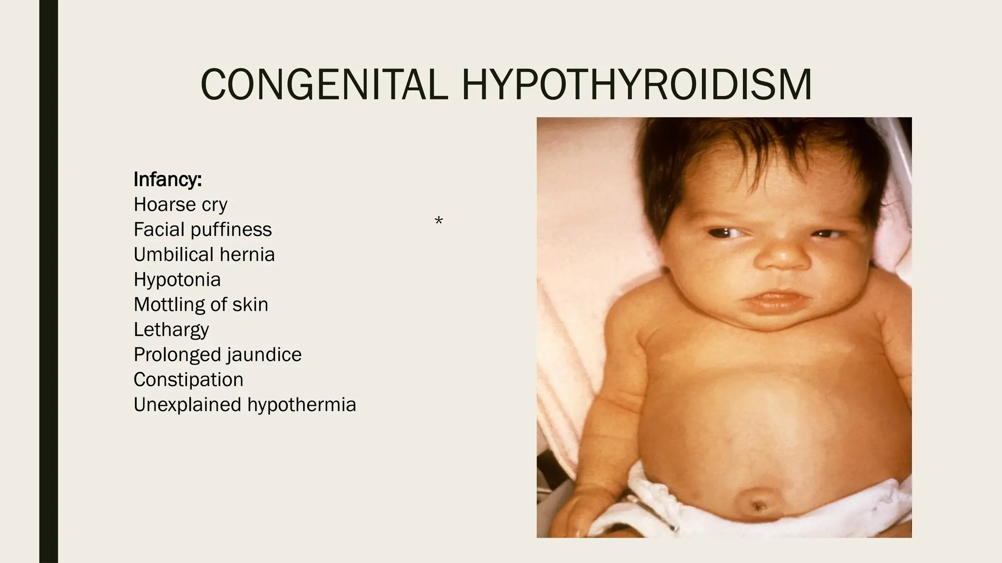 hypothyroidism pediatrics and medicine ppt | PPTX